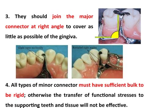 5 Minor Connectors Removable Partial Denture Ppt