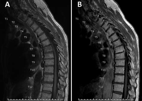 Osteomyelitis X Ray Spine