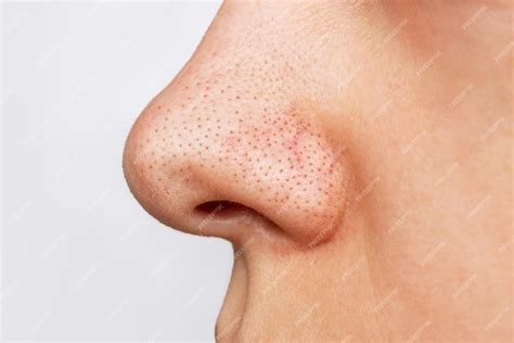 Closeup Of A Womans Nose With Blackheads Or Black Dots Acne Problem