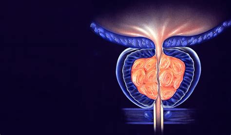 ¿qué Es La Prostatitis Urólogo En Culiacán Dr Luis Guerra