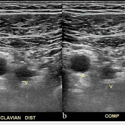 Non Compressible Subclavian Vein Suggesting Deep Vein Thrombosis Panel Download Scientific