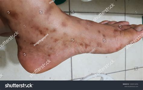 Black Spots On My Foot Flash Sales