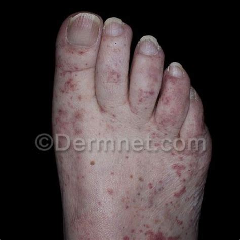 Soebskin Disease Vasculitis Generator · Hugging Face