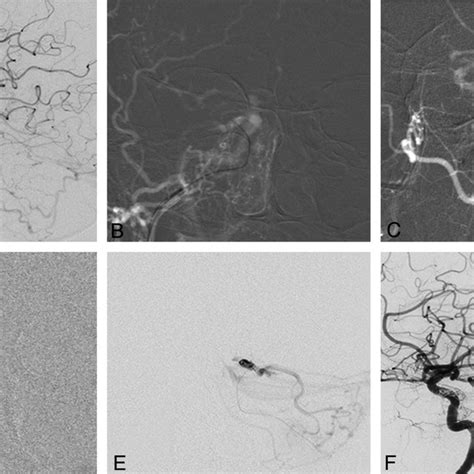 Dural Avf Of An Isolated Sss With Cortical Venous Reflux An