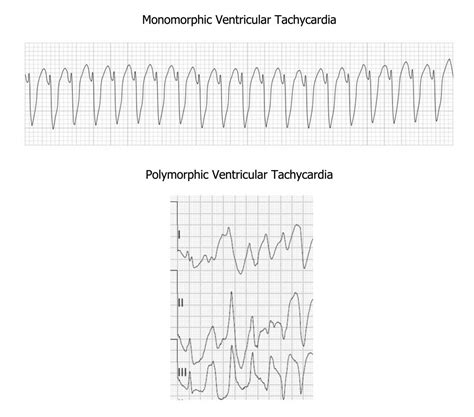 Arrhythmias Cardiovascular Pathophysiology For Pre Clinical Students