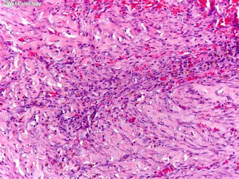 Chronic Pancreatitis Hereditary