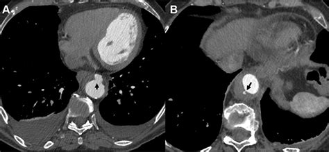 Diagnosing Aortic Intramural Hematoma Current Perspectives Vhrm