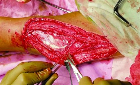 Identification Of Perforators—two In This Case Download Scientific