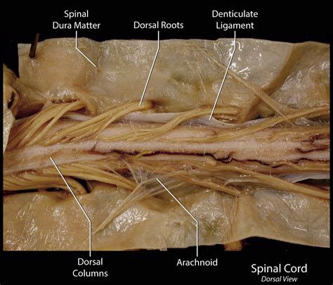 Spinal Meninges