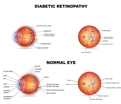 Diabetic Eye Disease Overview Causes Symptoms Treatment