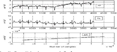 Figure 11 From Detection Of Indeterminacies In Corrected Ecg Signals