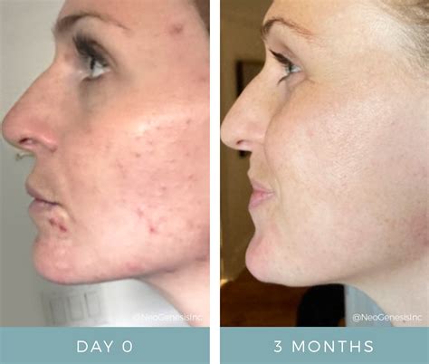 Acne Hormonal