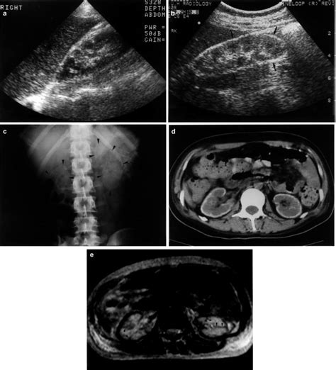 Nephrocalcinosis Springerlink