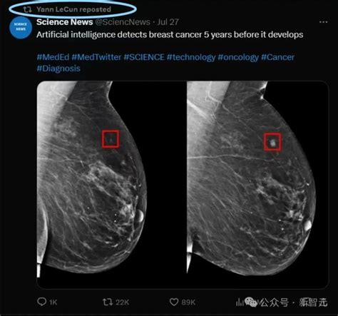 Ai模型提早5年预警乳腺癌，mit研究登science获lecun转发 腾讯新闻