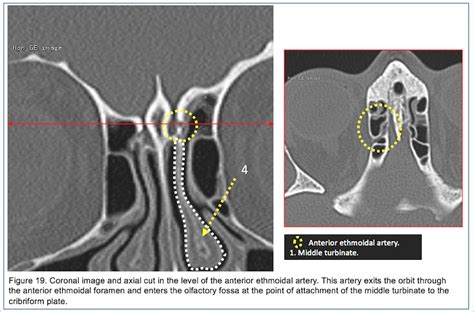 Anterior Ethmoidal Foramen