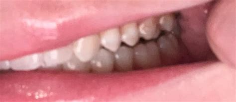 Wisdom Teeth Rinvisalign