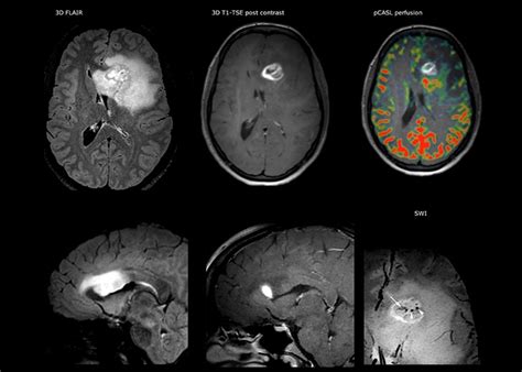 Mri Brain Tumor Vs Normal