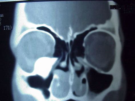 Maxillary Osteoma Of Right Side On Ct Scan Download Scientific Diagram
