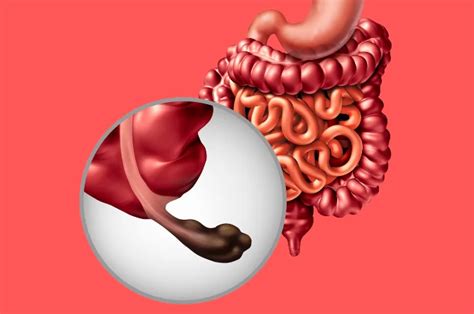 Best Hospital For Appendectomy Surgery In India Medisuggest