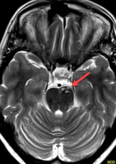 Cavernomas Do Sistema Nervoso Central Clinica Maddalozzo