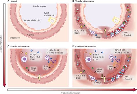 Acute Respiratory Distress Syndrome Causes Pathophysiology And