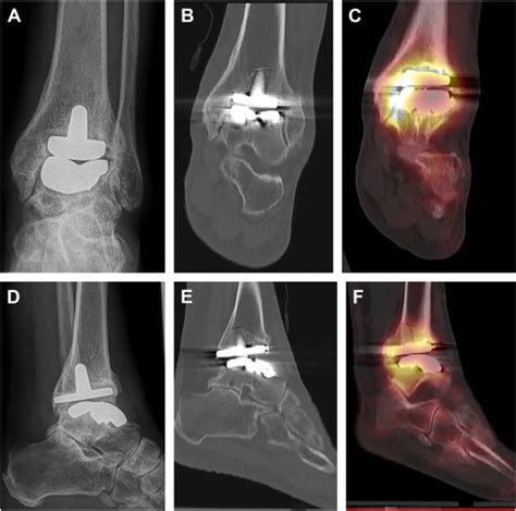 Spectct Of Total Ankle Arthroplasty Foot And Ankle Clinics