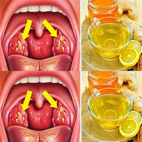 Natural Remedies For Tonsillitis Soothe Your Throat And Find Relief