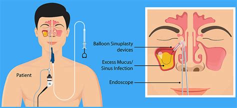 Sinus Surgery Advanced Ent Care