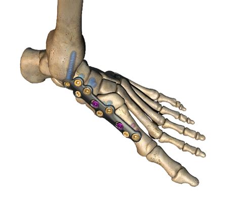Salvation 3di Plating System Stryker