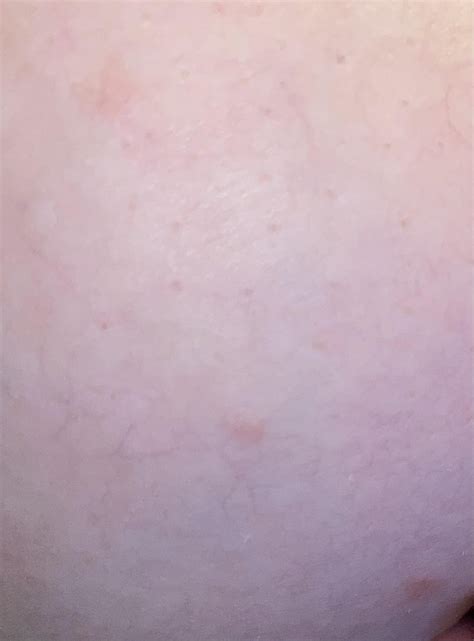 Red Spots On Breast That Come And Go At Frank Paxton Blog