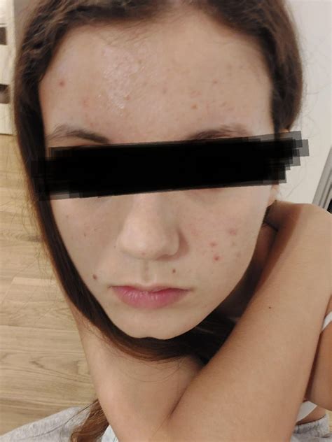 Acne Hyperpigmentation Racne