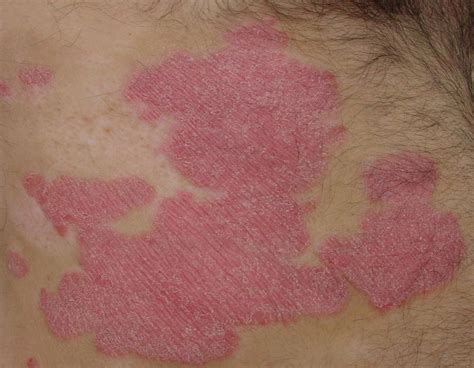 Comprendre Le Psoriasis Symptômes Types Et Traitements