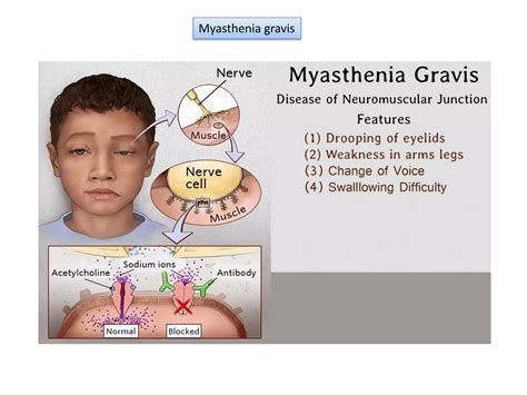 Type Ii Hypersensitivity Antibody Mediated Cytotoxic Hypersensitivity Pdf