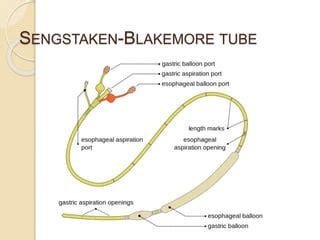 Sengstaken Blakemore Tube For Pph