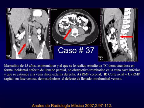 Diagnostico Incidental De Trombosis Abdominopelvica Por Tomografia
