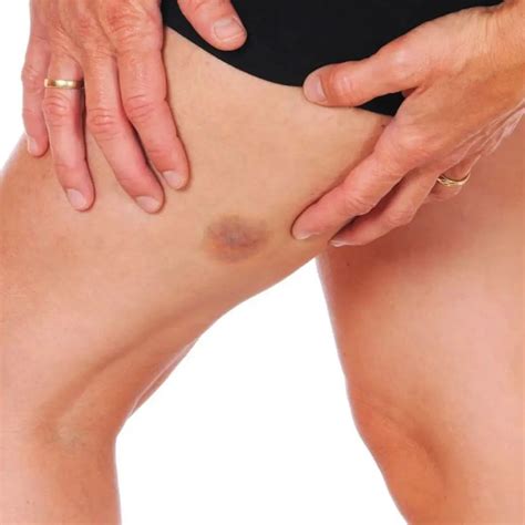 Waking Up With Bruises On Your Legs A Dangerous Sign That You Should