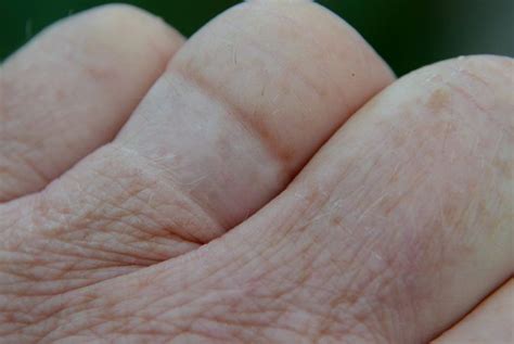 Anasarca Generalized Edema Health And Detox And Vitamins