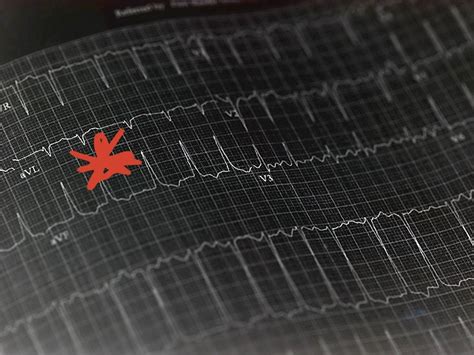 Afib Could Untreated Atrial Fibrillation Cause Cognitive Decline