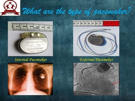 Pulse Generator Vs Pacemaker At Isaac Oppen Blog