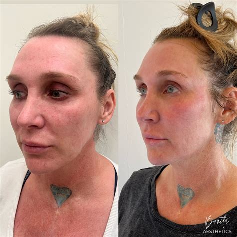 Morpheus Face Bonita Aesthetics Of Sacramento