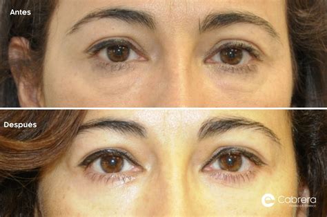 Antes Y Después En Blefaroplastia Dr Emilio Cabrera