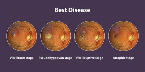 Dystrophy Stages Stock Illustrations 7 Dystrophy Stages Stock Illustrations Vectors And Clipart