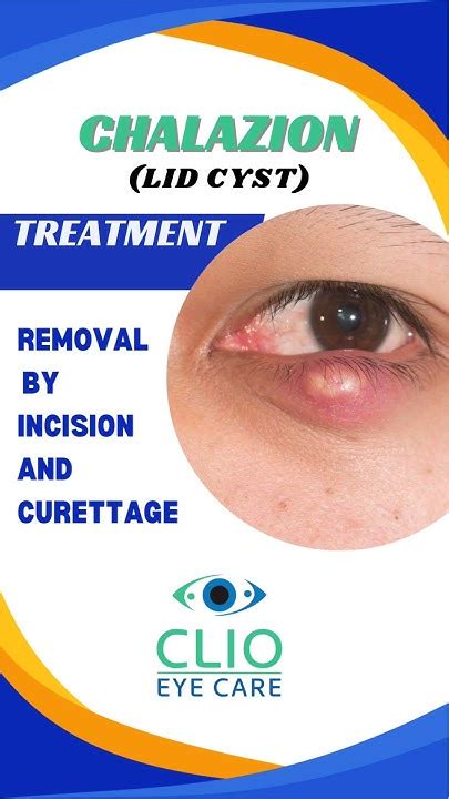 Chalazion Treatment Incision And Curettage Clio Eye Care Youtube