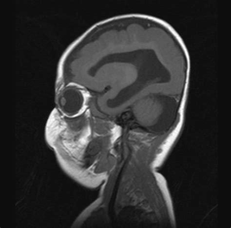 Global Developmental Delay Neuropediology