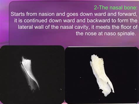 Lateral Cephalometric Analysis In Orthodontic Ppt