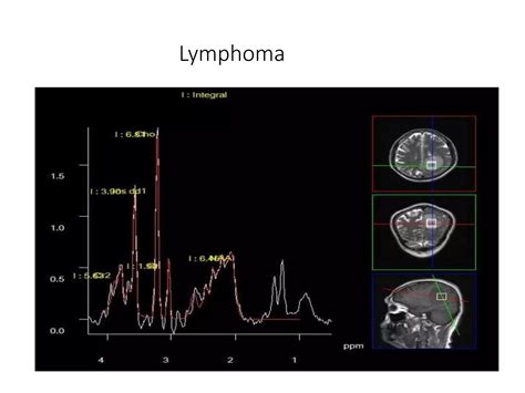 Mri Spectroscopy Its Application Principle And Techniques Pptx