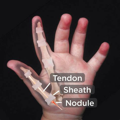 Trigger Finger Trigger Thumb Symptoms Causes Treatmen