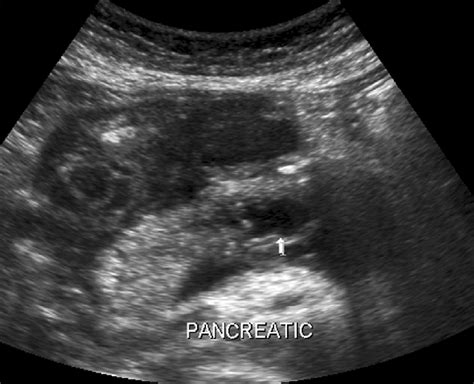 Transverse Sonogram Showing A Poorly Defined Heterogeneous Hypoechoic