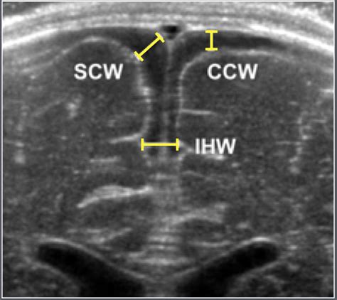 The Radiology Assistant Normal Values Ultrasound
