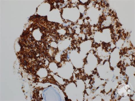 Lymphoplasmacytic Lymphoma Cd20